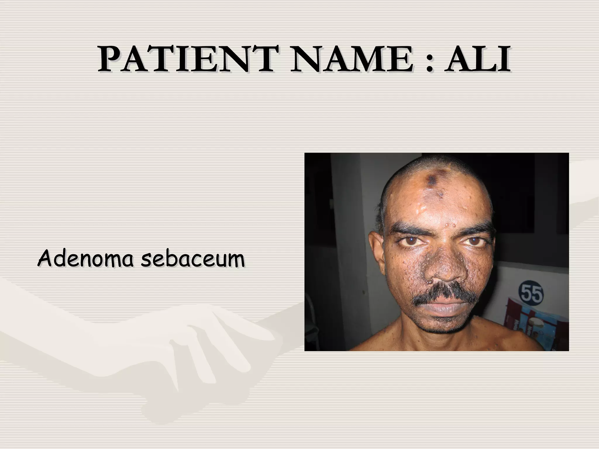 Tuberous sclerosis | PPT