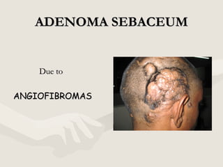 Tuberous sclerosis | PPT