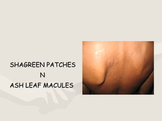 Tuberous sclerosis | PPT