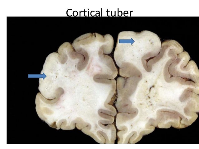 Tuberous sclerosis