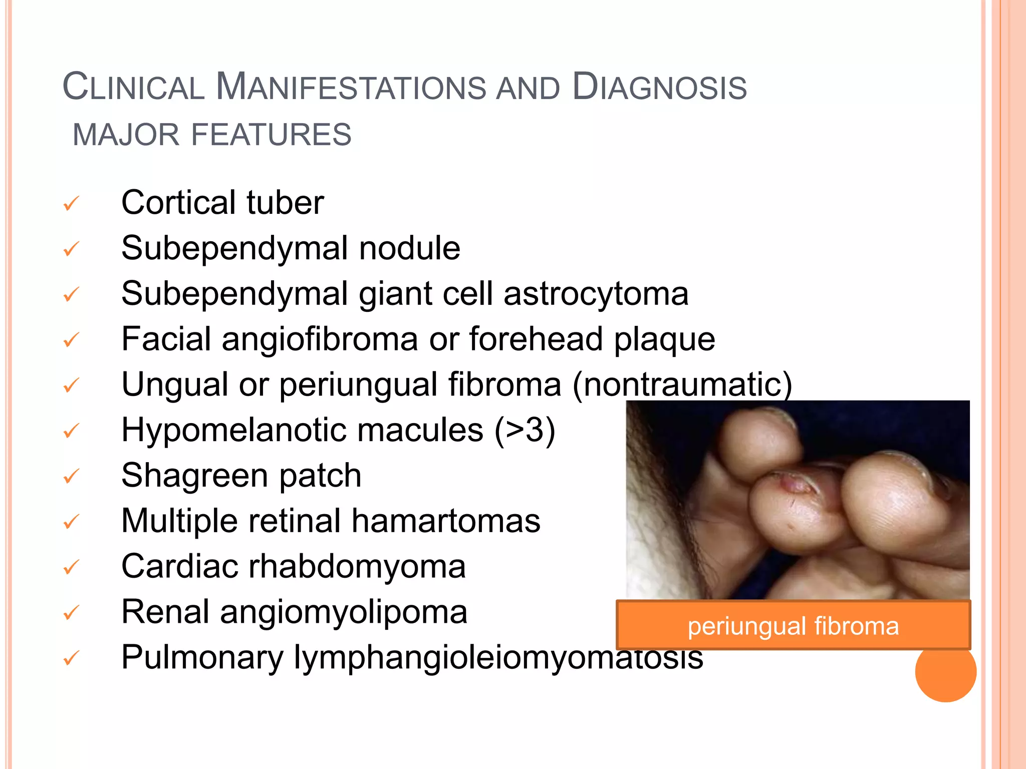 Tuberous sclerosis | PPTX
