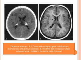Tuberous sclerosis | PPTX