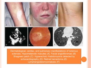 Tuberous sclerosis | PPTX