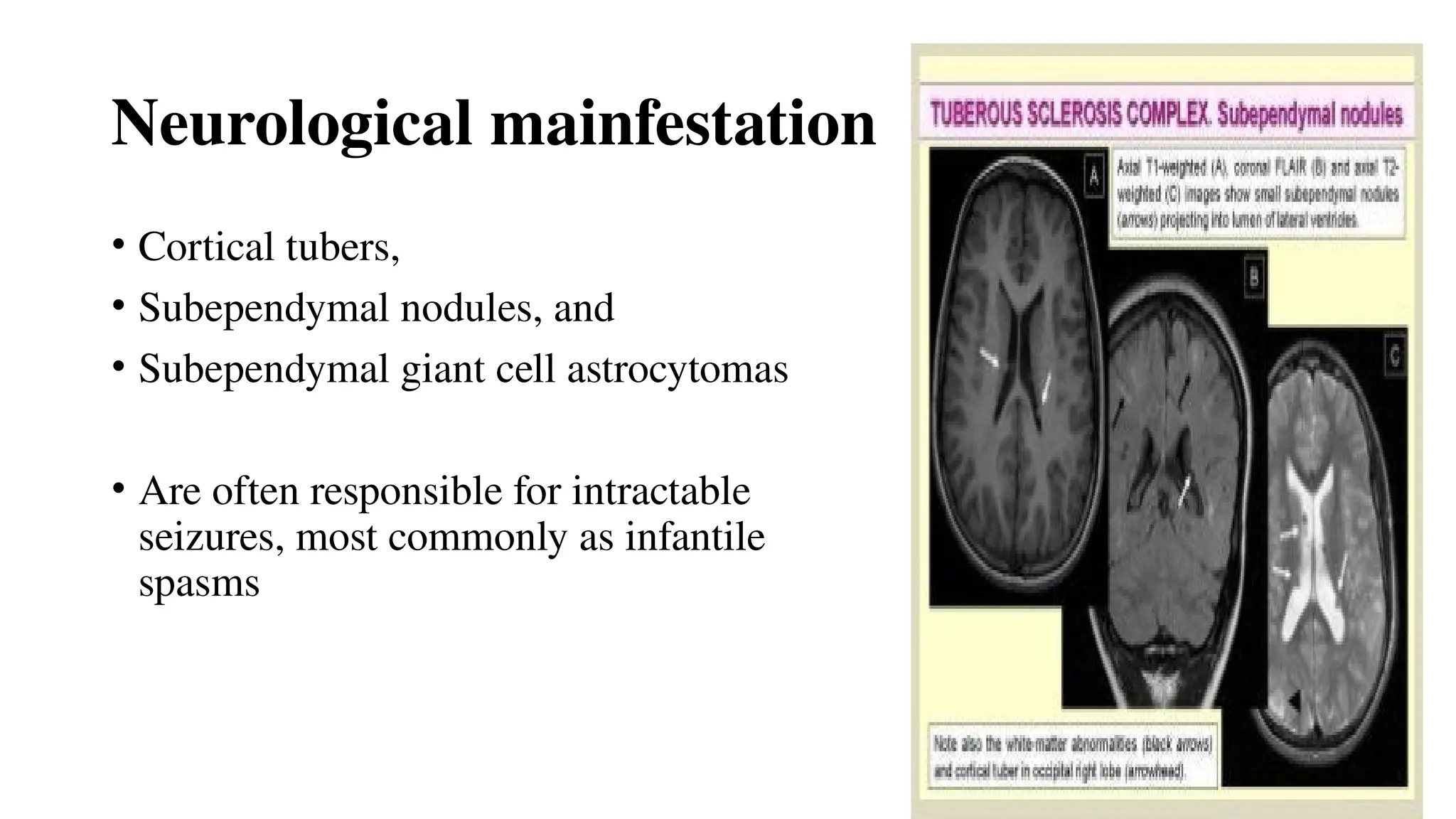 Tuberous sclerosis is one of the neurocutaneous syndromes | PPTX