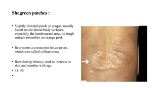 Tuberous sclerosis is one of the neurocutaneous syndromes | PPTX