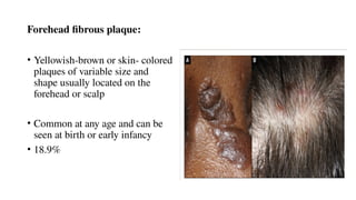 Tuberous sclerosis is one of the neurocutaneous syndromes | PPTX