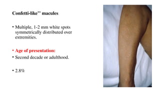 Tuberous sclerosis is one of the neurocutaneous syndromes | PPTX