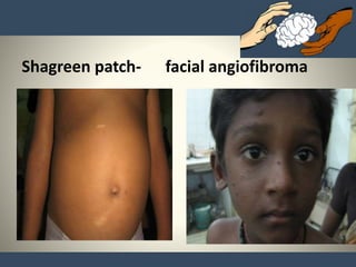 Tuberous sclerosis dr. amit vatkar, pediatric neurologist | PPTX