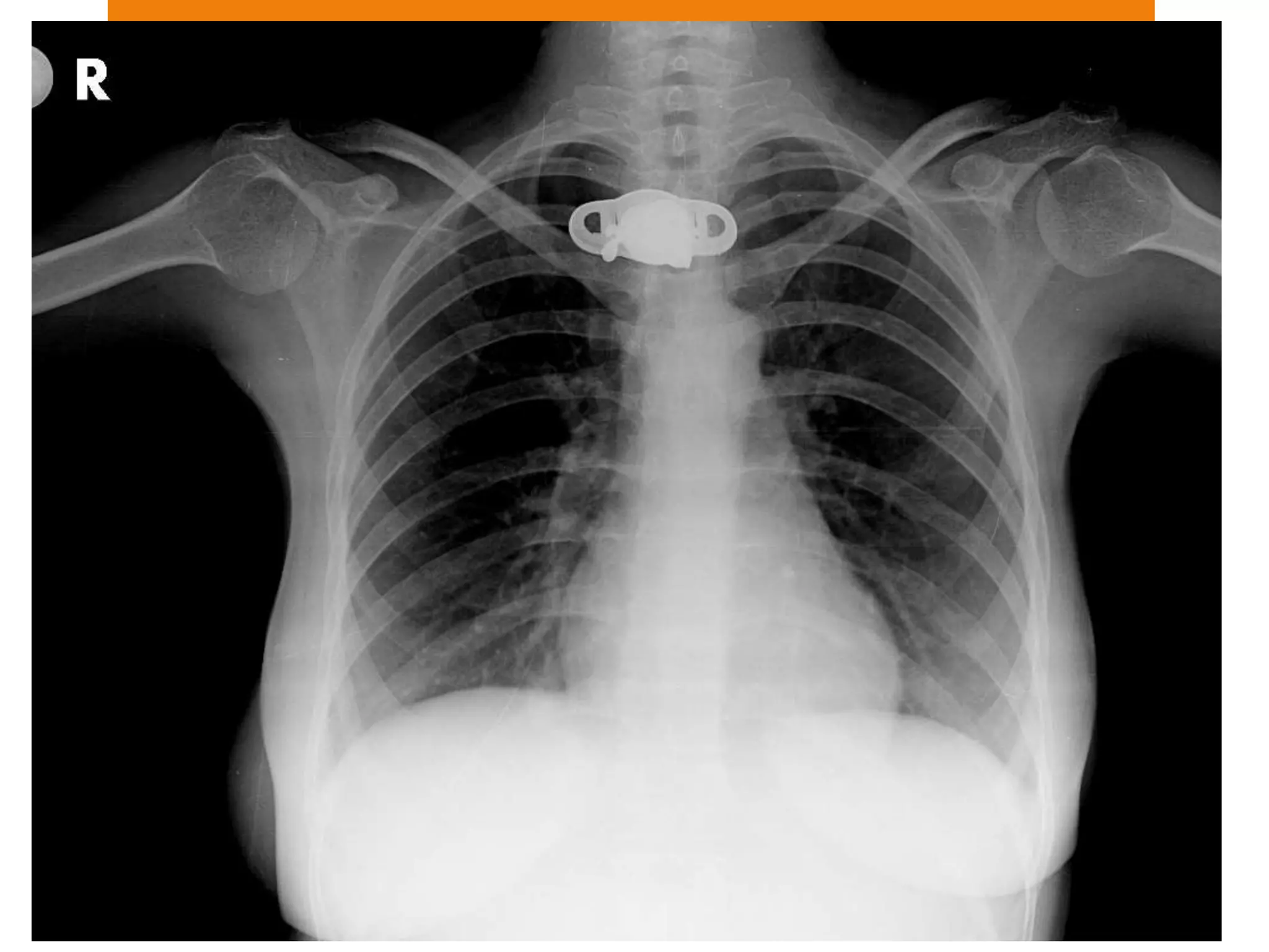 Chest tubes and lines | PPTX