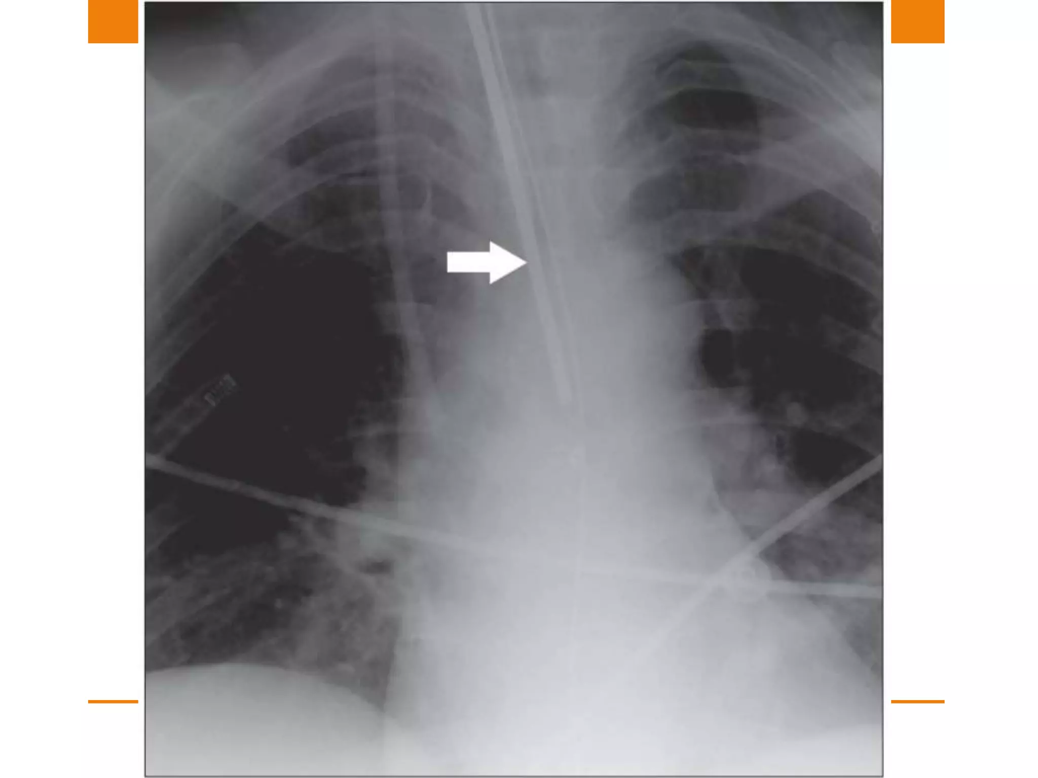 Chest tubes and lines | PPTX