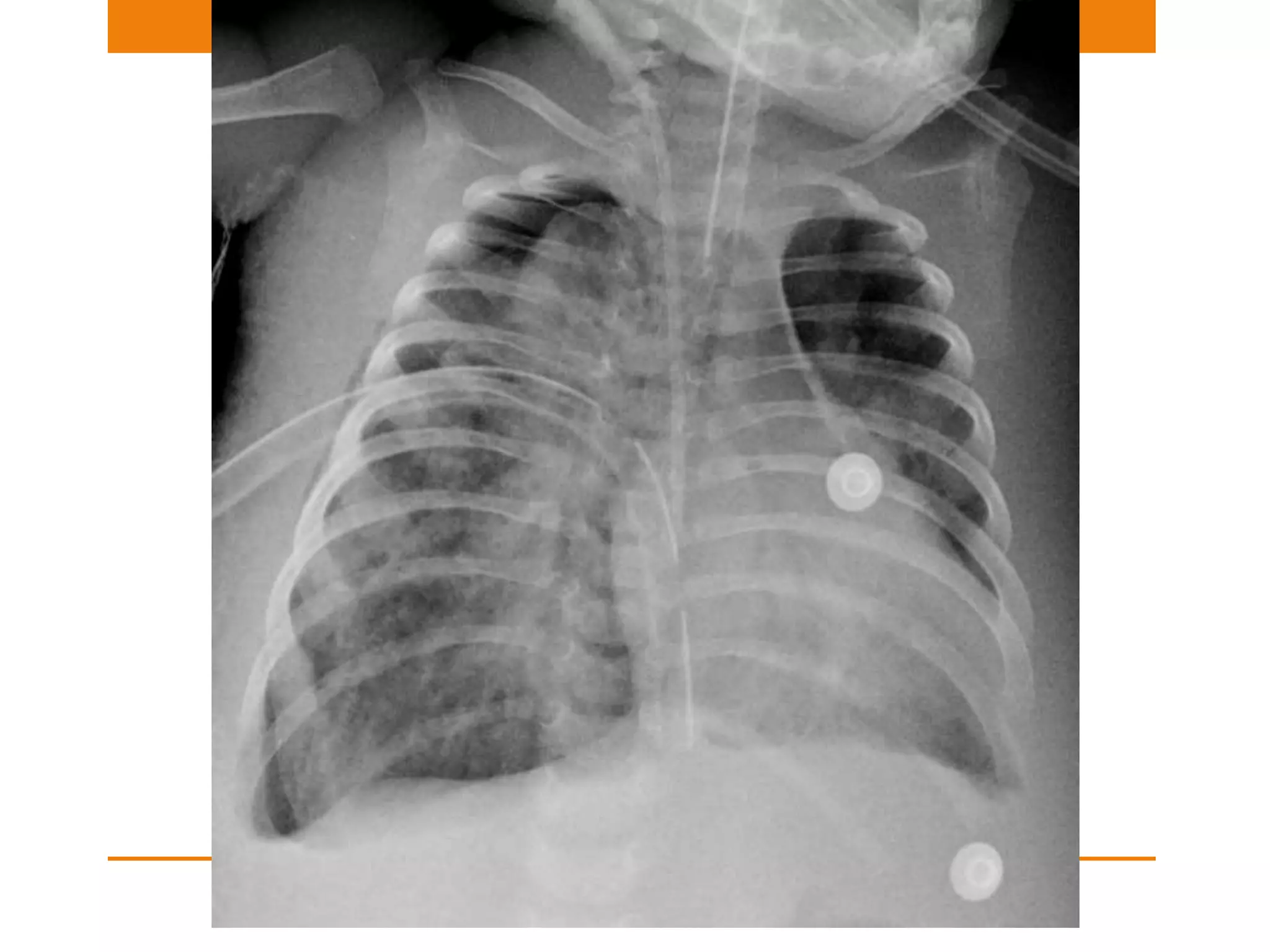 Chest tubes and lines | PPTX