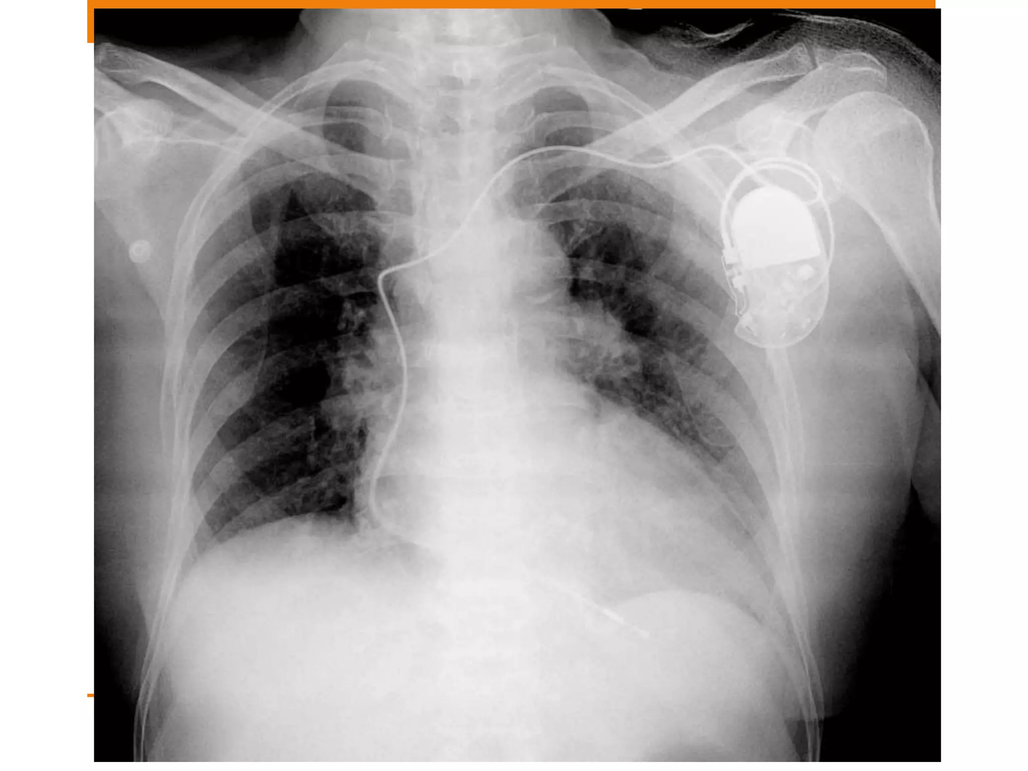 Chest tubes and lines | PPTX
