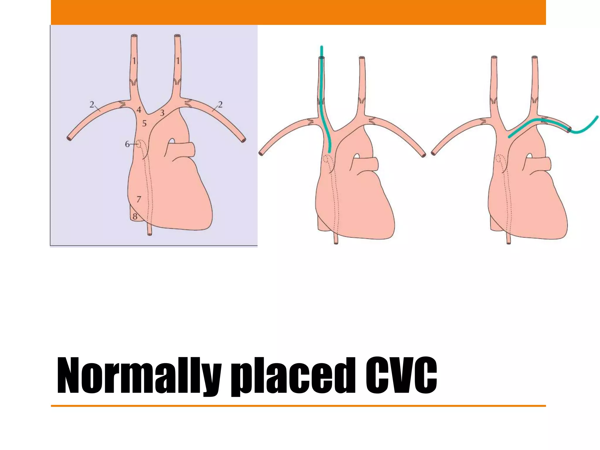 Chest tubes and lines | PPTX