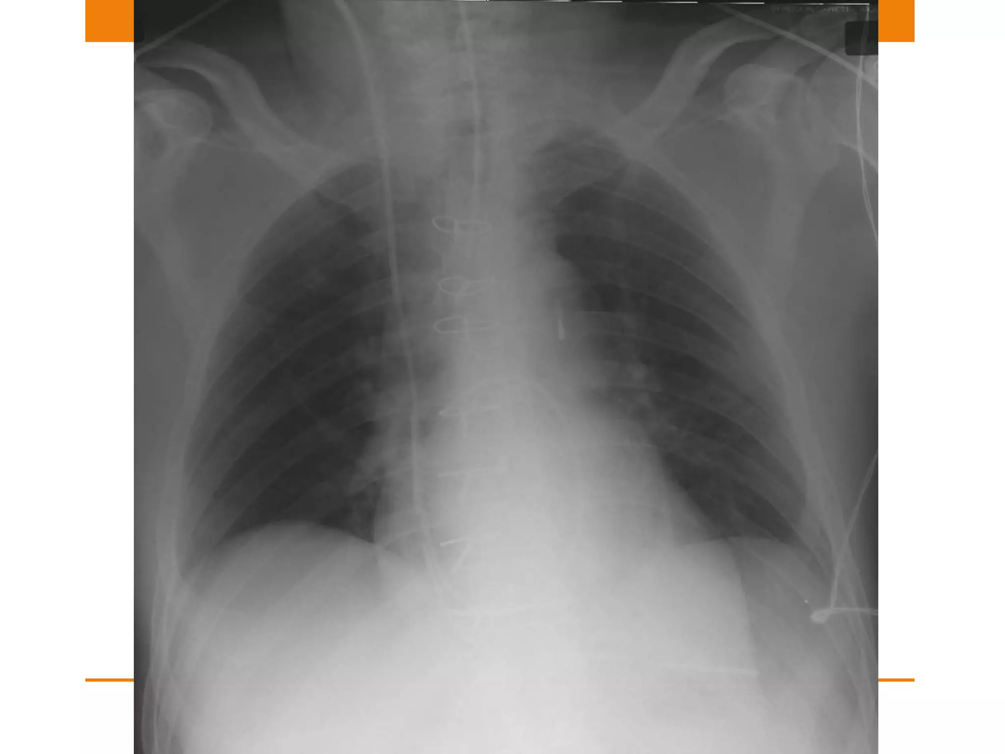 Chest tubes and lines | PPTX