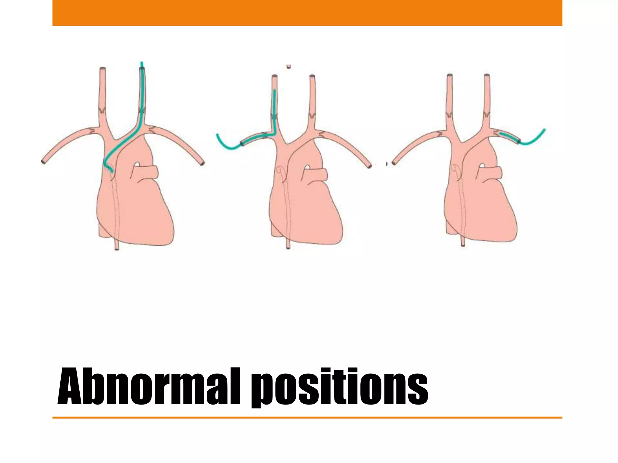 Chest tubes and lines | PPTX