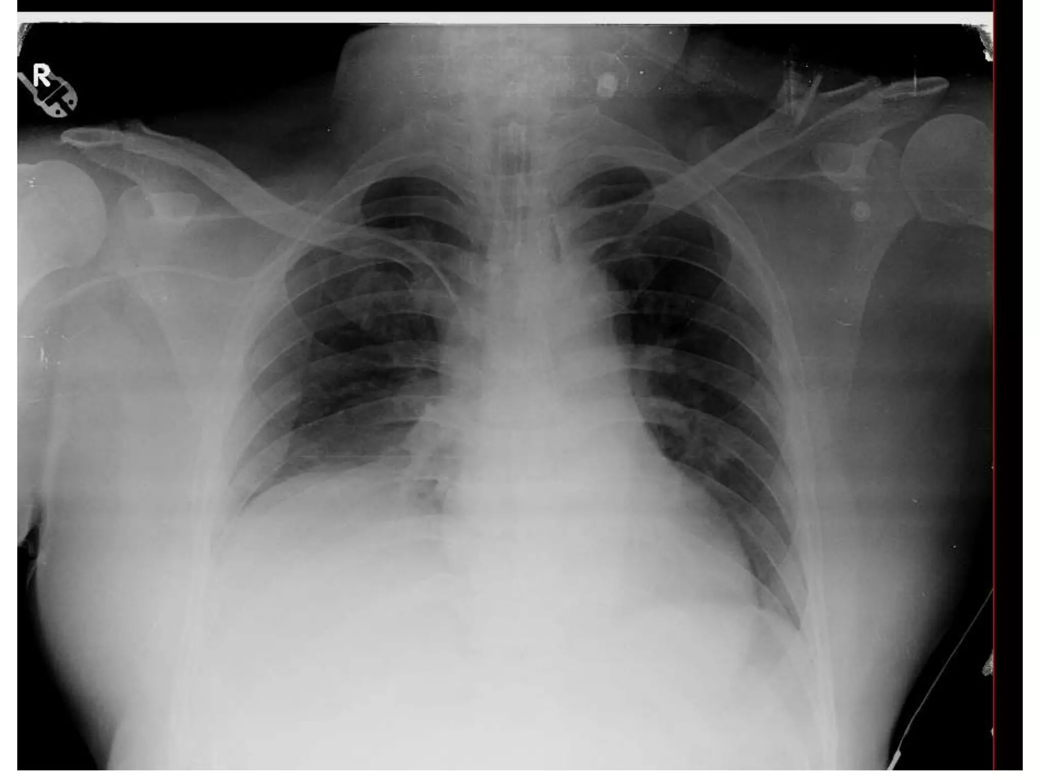 Chest tubes and lines | PPTX