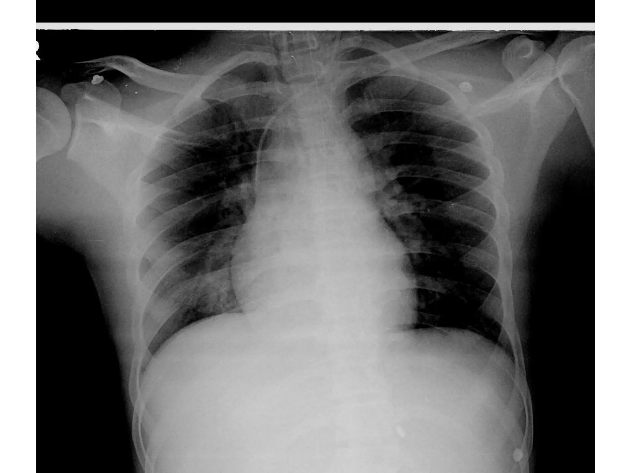 Chest tubes and lines | PPTX