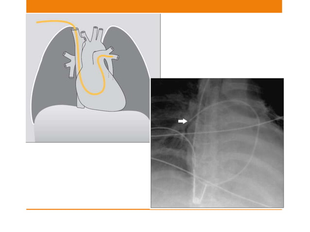 Chest tubes and lines | PPTX | Heart and Cardiovascular Diseases ...
