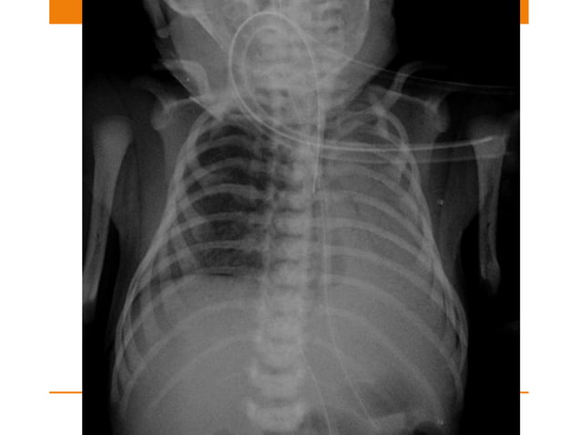 Chest tubes and lines | PPTX | Heart and Cardiovascular Diseases ...