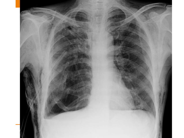 Chest tubes and lines | PPTX | Heart and Cardiovascular Diseases ...