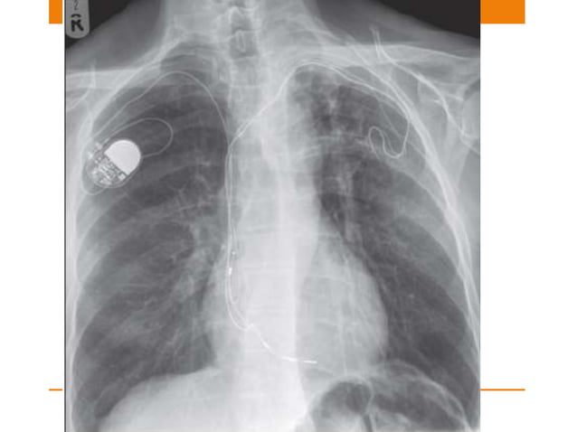 Chest tubes and lines | PPTX | Heart and Cardiovascular Diseases ...