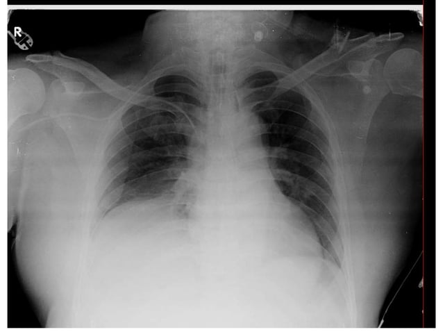 Chest tubes and lines | PPTX | Heart and Cardiovascular Diseases ...