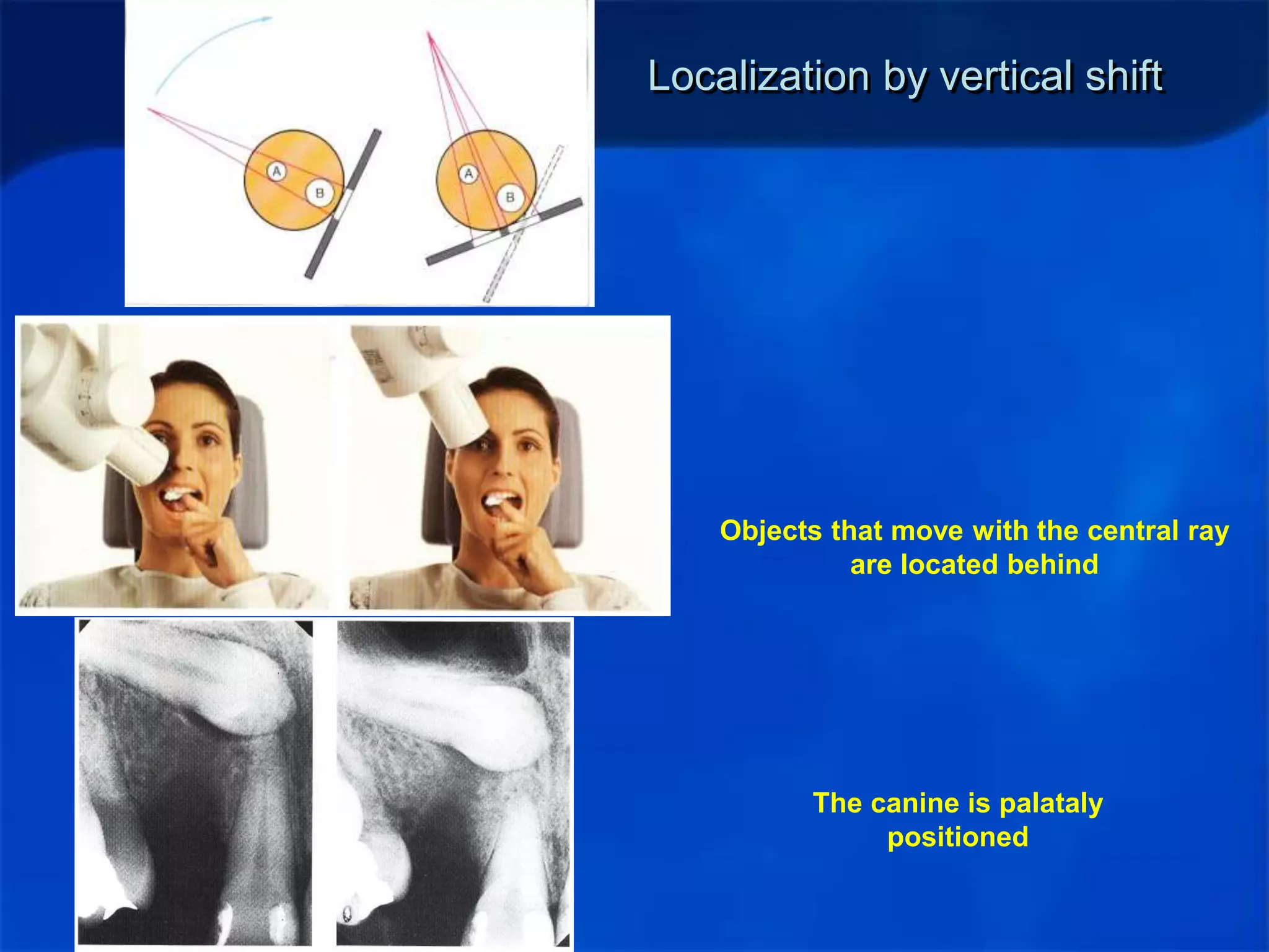 Tube Shift Technique | PPSX