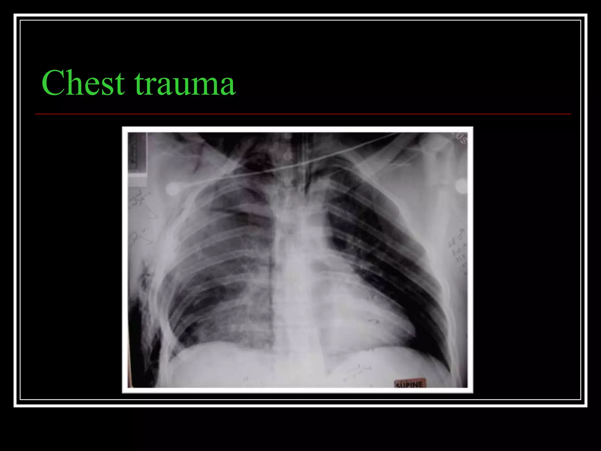 Tube thoracostomy | PPTX