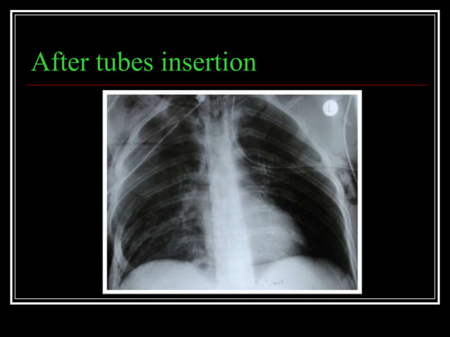 Tube thoracostomy | PPTX