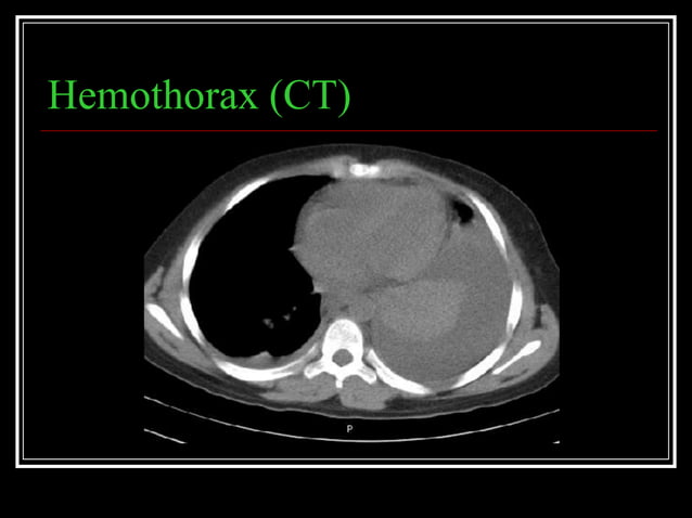 Tube thoracostomy | PPTX