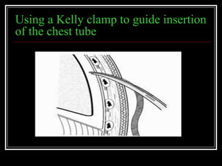Kelly Clamp Chest Tube