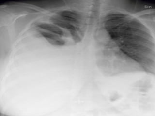 Tube Thoracostomy, Management | PPT