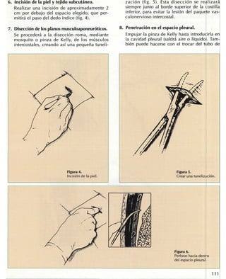 Tubo torax 1 | PDF