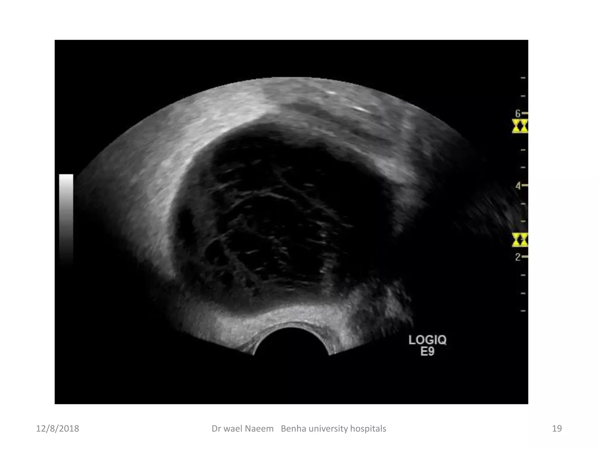 Tubo ovarian absess | PPTX