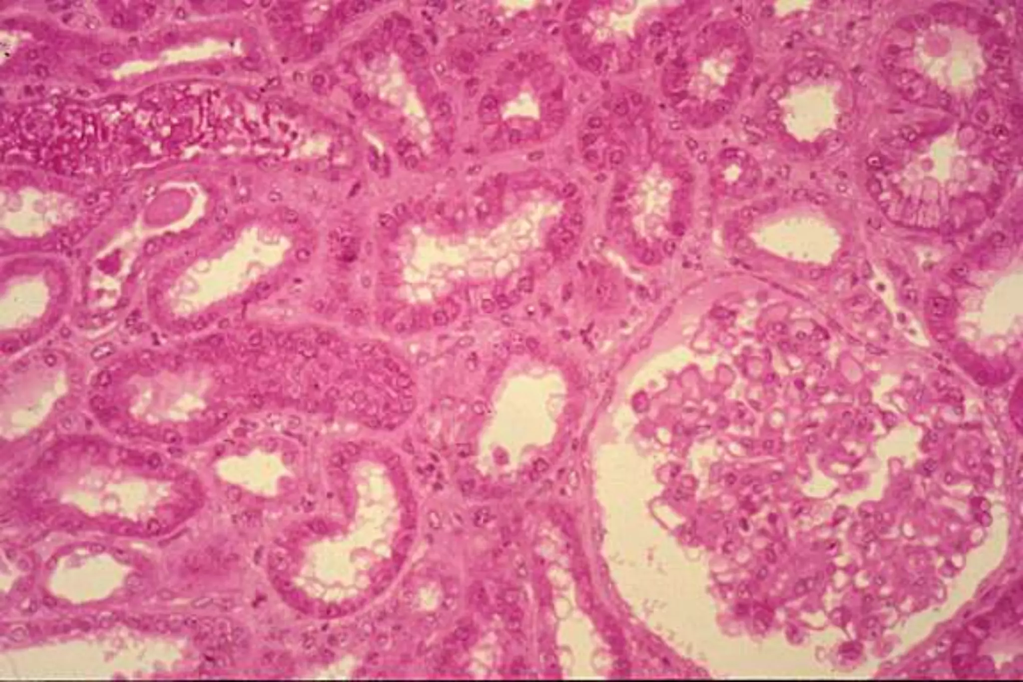 tubulo-interstitial-nephropathy (1).ppt