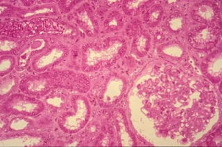 tubulo-interstitial-nephropathy (1).ppt