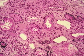 tubulo-interstitial-nephropathy (1).ppt