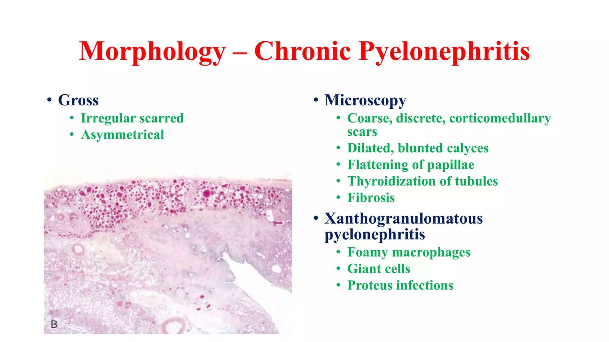 Tubulointerstitial diseases | PPTX