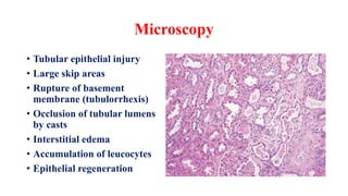 Tubulointerstitial diseases | PPTX