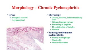 Tubulointerstitial diseases | PPTX