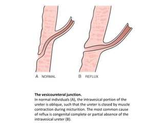 Tubulointerstitial nephritis | PPTX