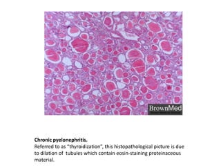 Chronic Pyelonephritis Histology