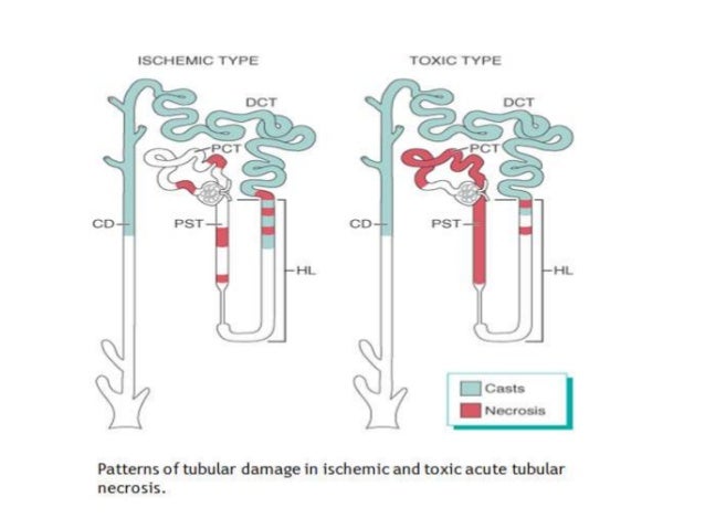 Tubulointerstitial nephritis