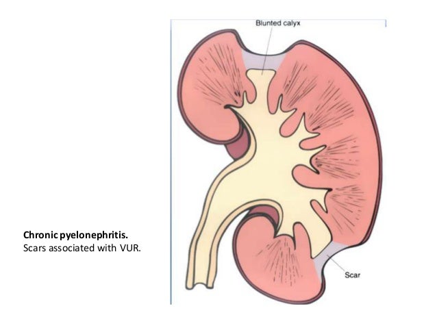 Tubulointerstitial nephritis