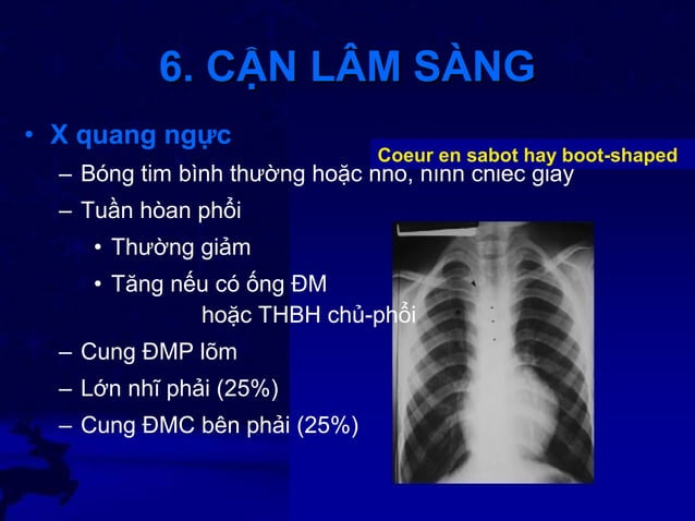 tứ chứng fallot ts.bs. Vũ Minh Phúc | PPT