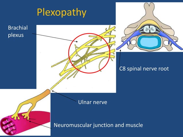 Tues 10-20 Peripheral Nerve Disorders- A Practical Overview.pptx