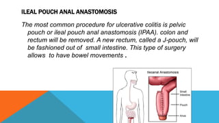 Ulcerative Colitis | PPT