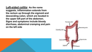 Ulcerative Colitis | PPT