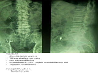 Radiologi - kelainan vertebrae | PPTX