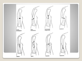 Fraktur Humerus | PPTX